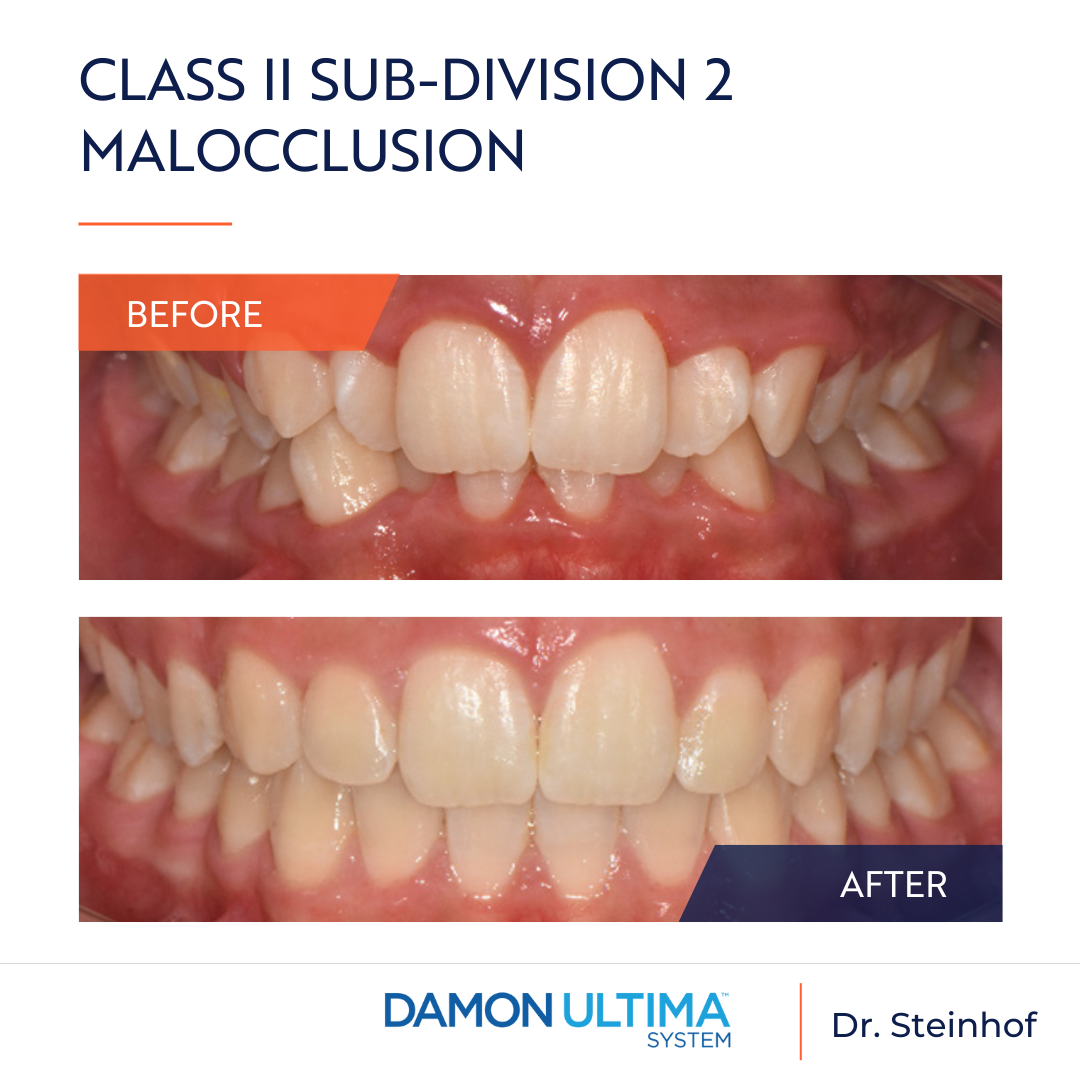 Malocclusione di Classe II seconda divisione con un significativo ...